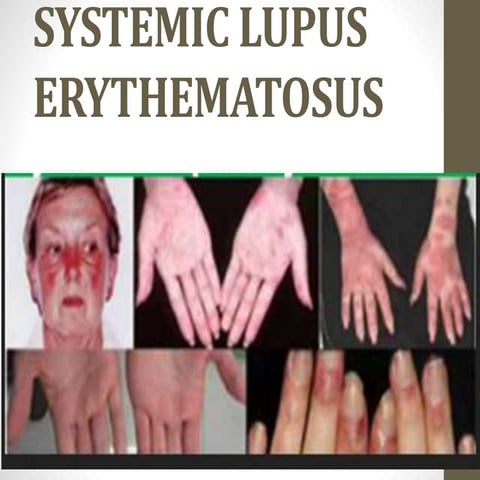 Systemic lupus erythematosus | PPT