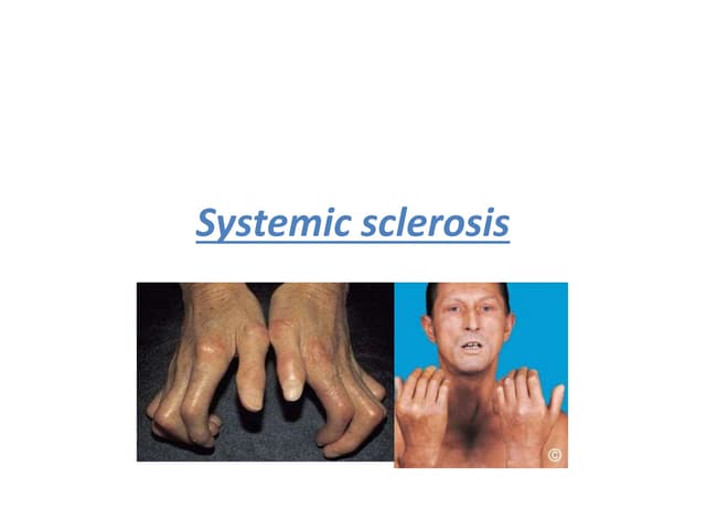 Systemic Sclerosis New Pptx