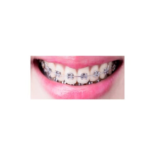 Braces | PPT