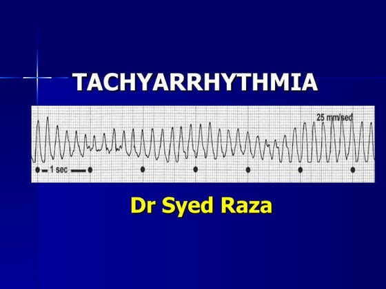 What Are the Key ECG Findings in Supraventricular Tachycardia? | PDF