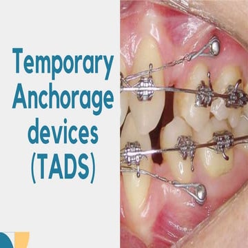 Temporary anchorage devices (TADs) .pptx