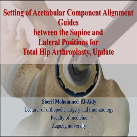 Acetabular component alignment guide in total hip replacement | PPT