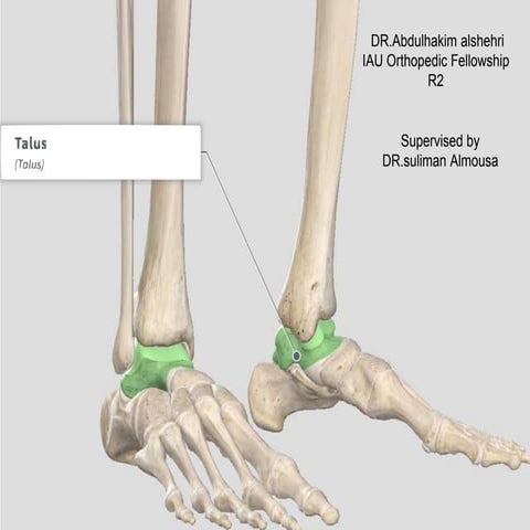 Talus fructures classification and managment | PPTX