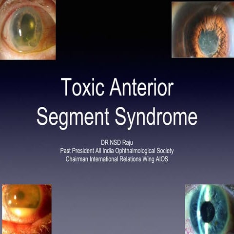 Causes of Toxic Anterior Segment Syndrome | PPTX | Eye and Vision ...
