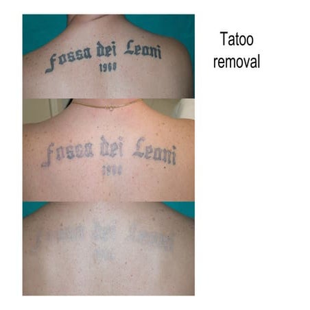 Tatoo removal rimozione tatuaggi | PDF