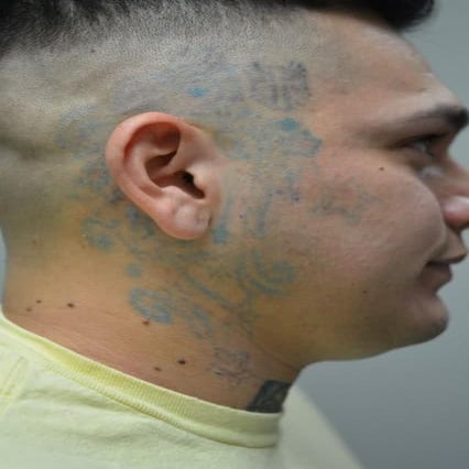 Tattoo removal ba | PDF