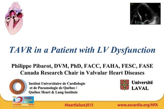 Essential Facts to Understand Before Undergoing a Transcatheter Aortic ...