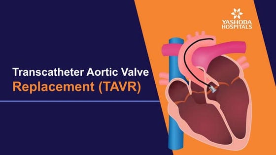 AVR - MVR all you need to know about Valve Repair & Replacement | PPT