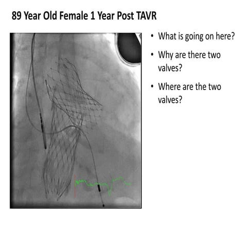 Tavr case review 3 18-14 | PPT