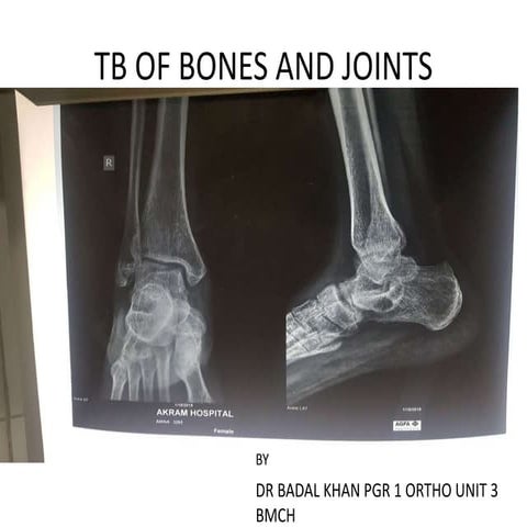Tb of bones and joints | PPTX