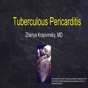 Tb Pericarditis | PPTX