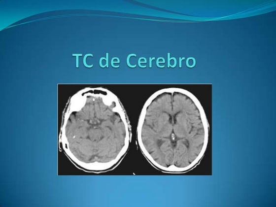 INTERPRETACION DE ANATOMIA CEREBRAL EN UNA TAC CRANEAL | PPT