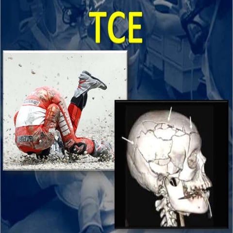 TCE. Traumatismo craneoencefálico, diagnóstico y tratamiento. | PPTX
