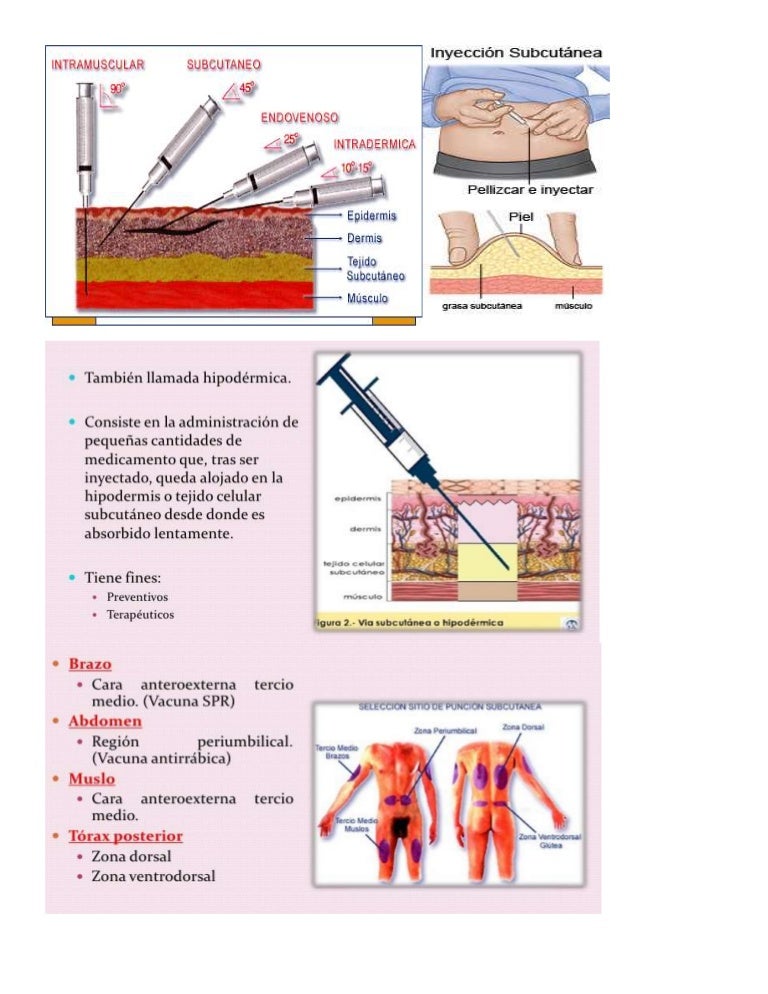 Técnica de inyección subcutanea