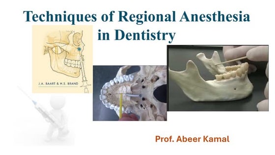 Posterior superior alveolar (psa) nerve block | PPT