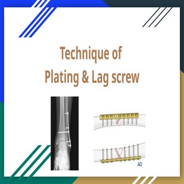 Technique of Plating & Lag screw slide sahre | PPTX