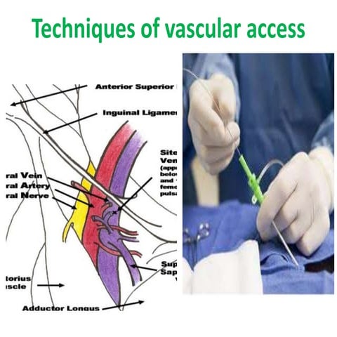 Femoral Artery Access for catheterization procedureure.pptx