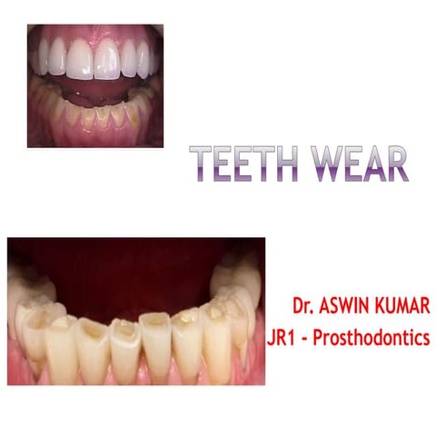 Teeth wear in dentistry-23456428763 converted.ppt
