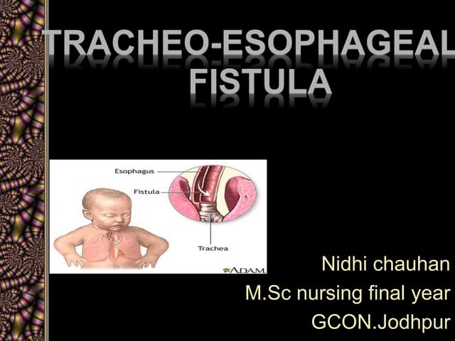Tracheo oesophageal fistula | PPTX