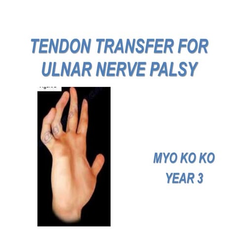 TENDON TRANSFER FOR ULNAR NERVE PALSY ppt | PPTX