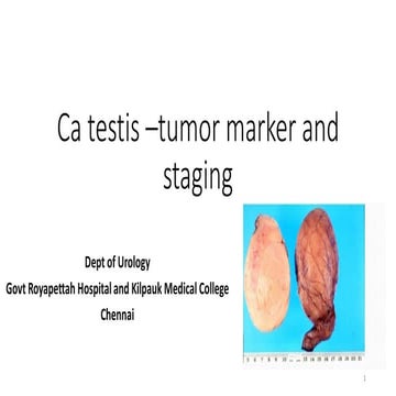 Testis carcinoma- staging & tumour markers | PPT