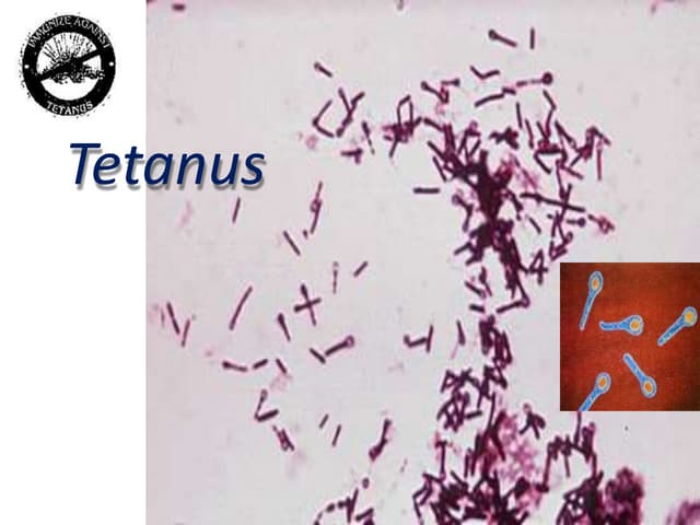 Tetanus | PPT