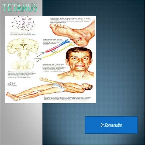 tetanus definisi dan penatalaksanaannya.ppt