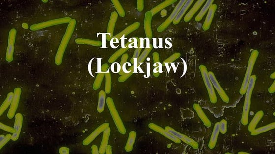 Clinical features of tetanus | PPTX