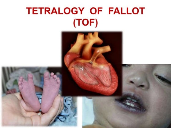 Tetralogy of fallot | PPT