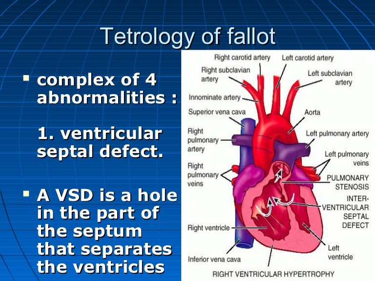 Tetrology of fallot