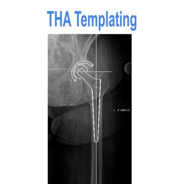 Summary of Total hip templating1111.pptx