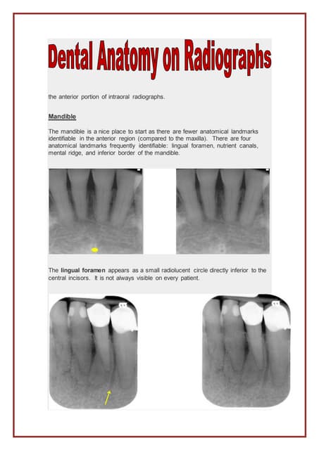 mandibular landmarks of radiograph | PPTX | Dental Health | Diseases ...