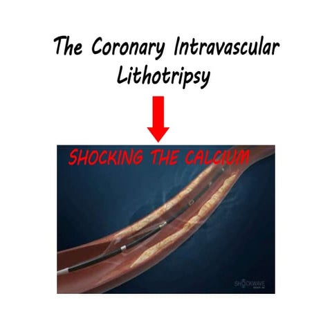 Coronary intravascular lithotripsy and lasers/ IVL | PPTX