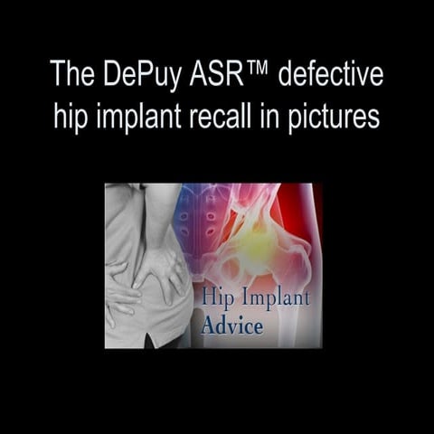 The Depuy ASR™ defective hip implant recall in pictures | PPT