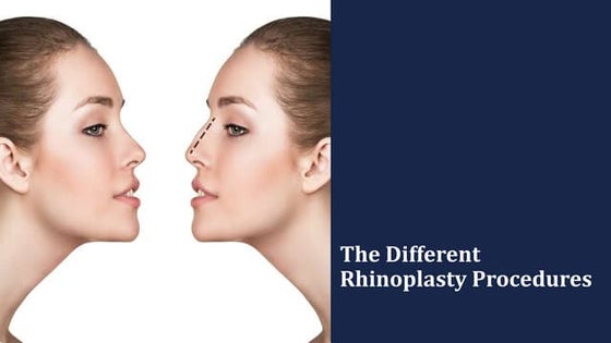 Types of Rhinoplasty Surgery | PDF | Ear, Nose and Throat Conditions ...