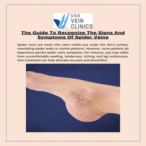 The Guide To Recognize The Signs And Symptoms Of Spider Veins | PDF