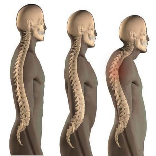 Compression Fracture | PDF