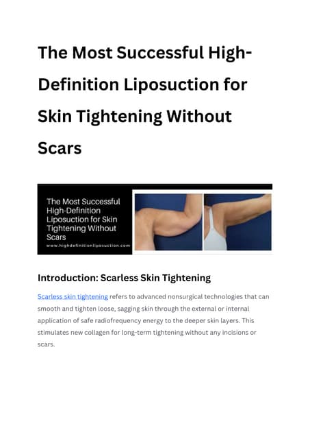 How RF Skin Tightening Can Transform Your Skin | PPT