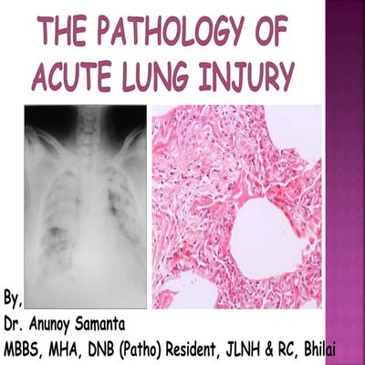 The Pathology of Acute Lung Injury | PPTX