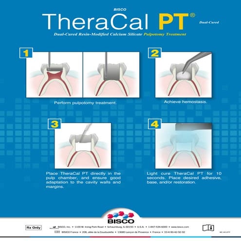TheraCal_PT_Technique_Card1.pdf for pulpotomy | PDF