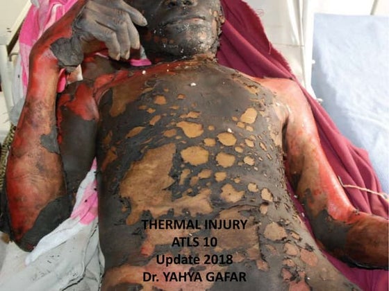 BURNS- Derm Presentation | PPTX | First Aid | Injuries