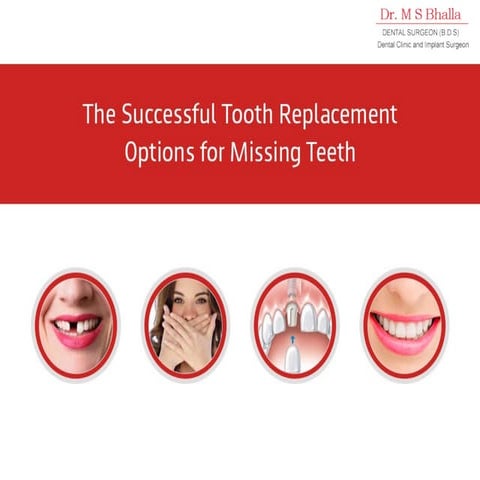 The Successful Tooth Replacement Options for Missing Teeth | PPT