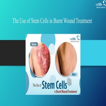 The use of stem cells in burnt wound treatment | PPT