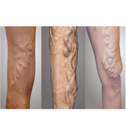 The White Army Varicose Veins Pdf