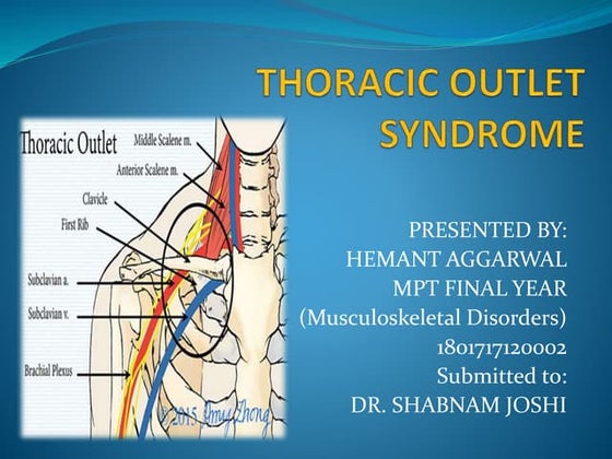 Thoracic outlet syndrome | PDF