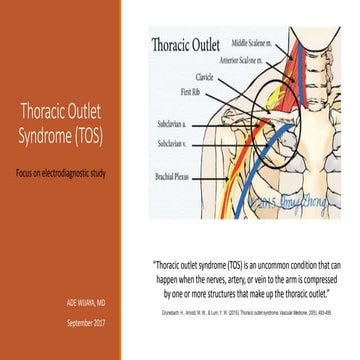 Thoracic Outlet Syndrome; Focus on Electrodiagnostic Studies | PPT