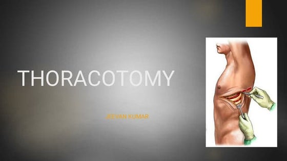 Thoracotomy | PPTX