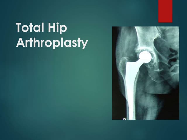 Anterior vs Posterolateral Surgical Approach in Primary Total Hip Art…