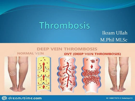 Thrombosis.ppt