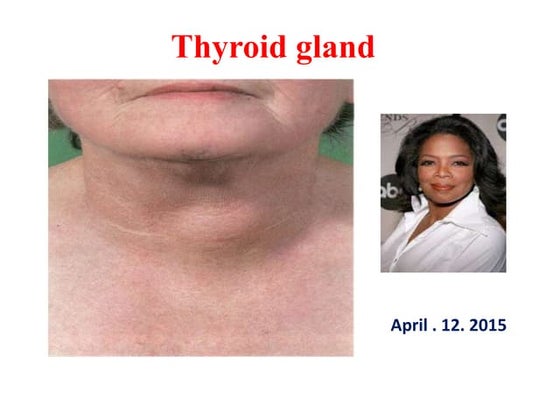 Thyroid non neoplastic lesions | PPTX | Thyroid Disorders | Endocrine ...
